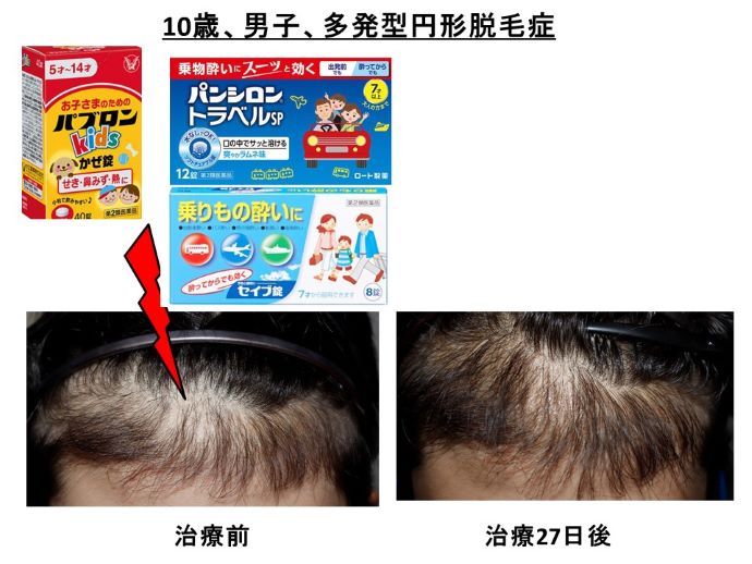 脱毛の原因であった酔い止めの薬の名前判明！ 患者様からの声・メディア掲載・クリニックからのお知らせ 名古屋kクリニック
